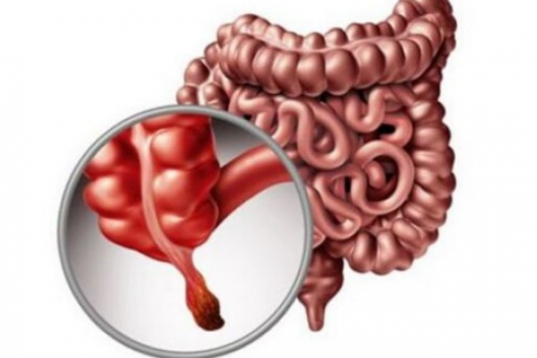 Cirugía de Apéndice | Cirugías Perú